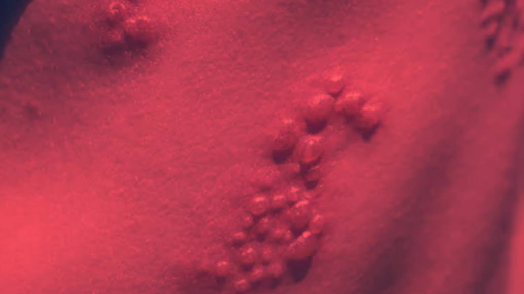 Red Light Therapy for Herpes - Improving Comfort Safely – RLT Home