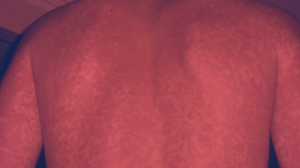 Red Light Therapy for Rash - Fast Recovery and Comfort – RLT Home